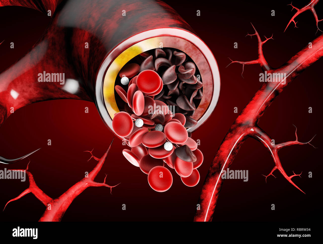 Sickle cell anemia hi-res stock photography and images - Alamy