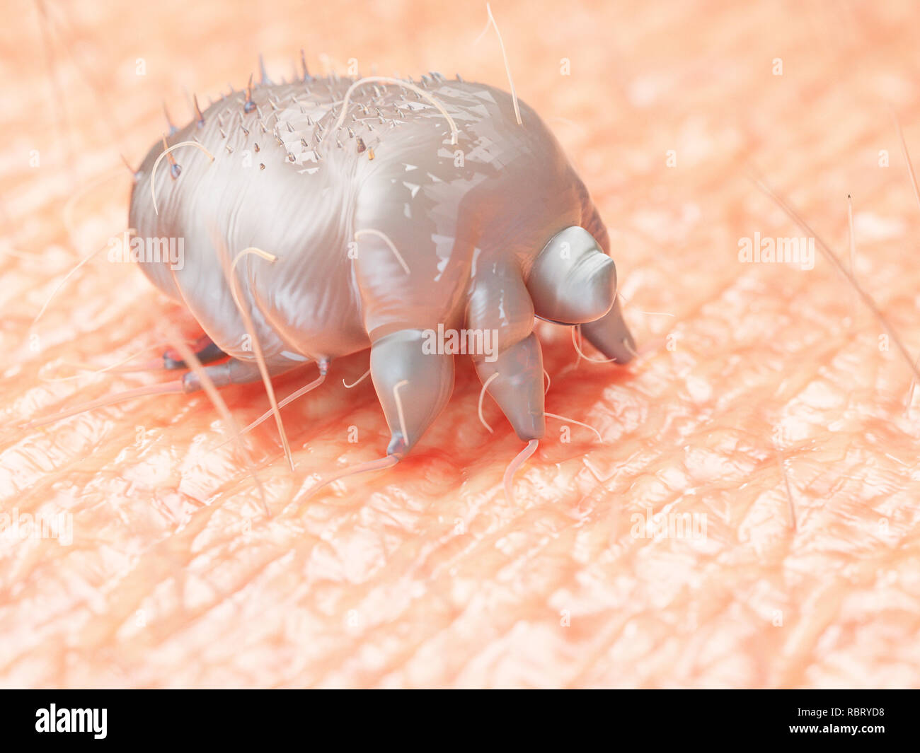 Illustration of a scabies mite on human skin Stock Photo - Alamy