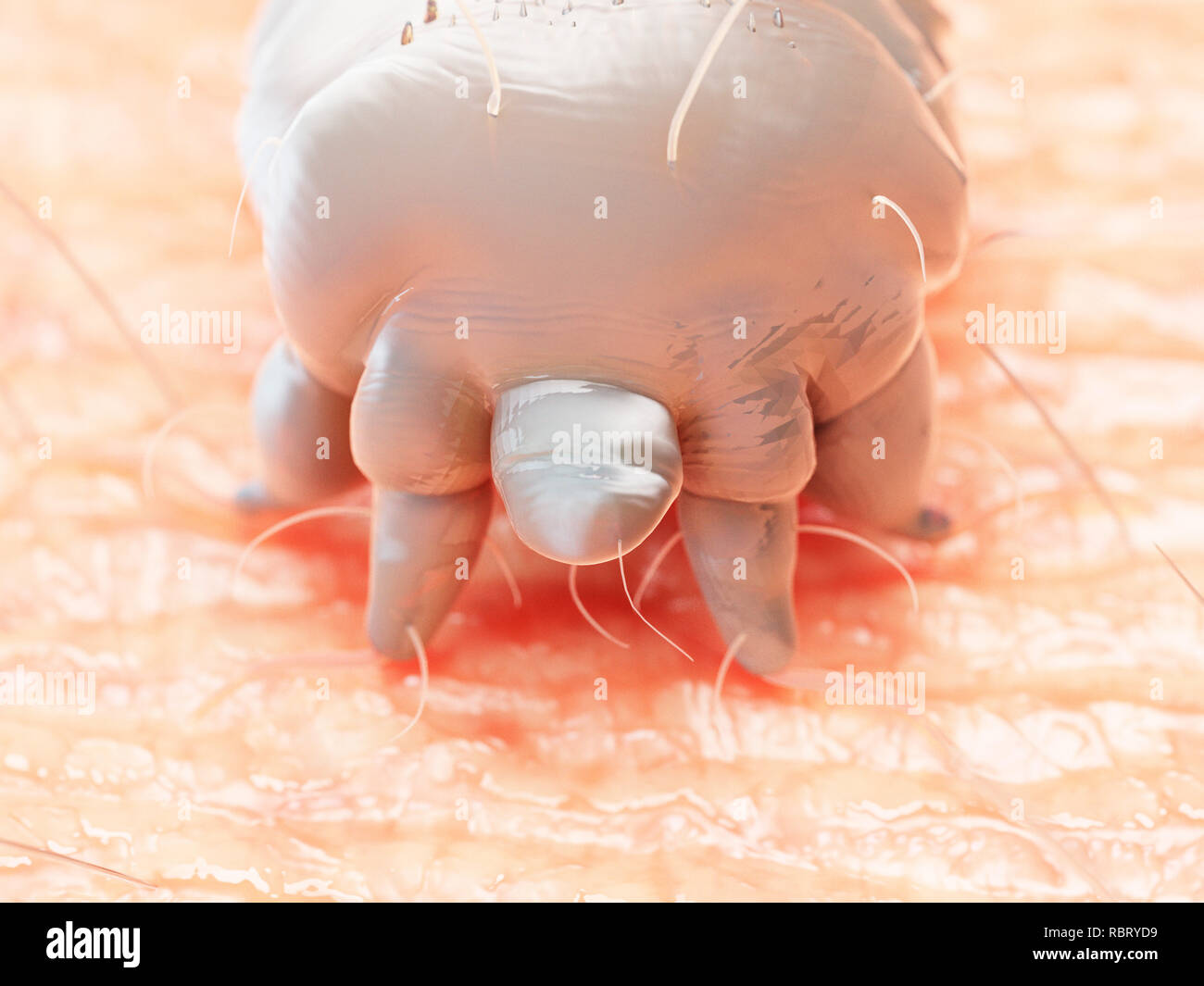 Illustration of a scabies mite on human skin Stock Photo - Alamy