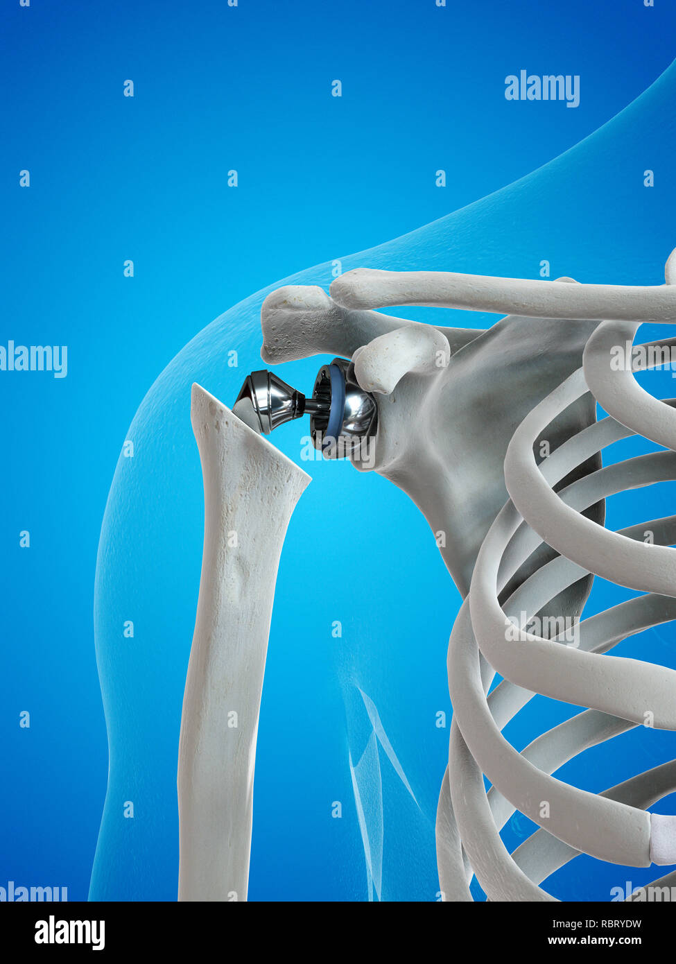 Illustration of a shoulder replacement Stock Photo - Alamy