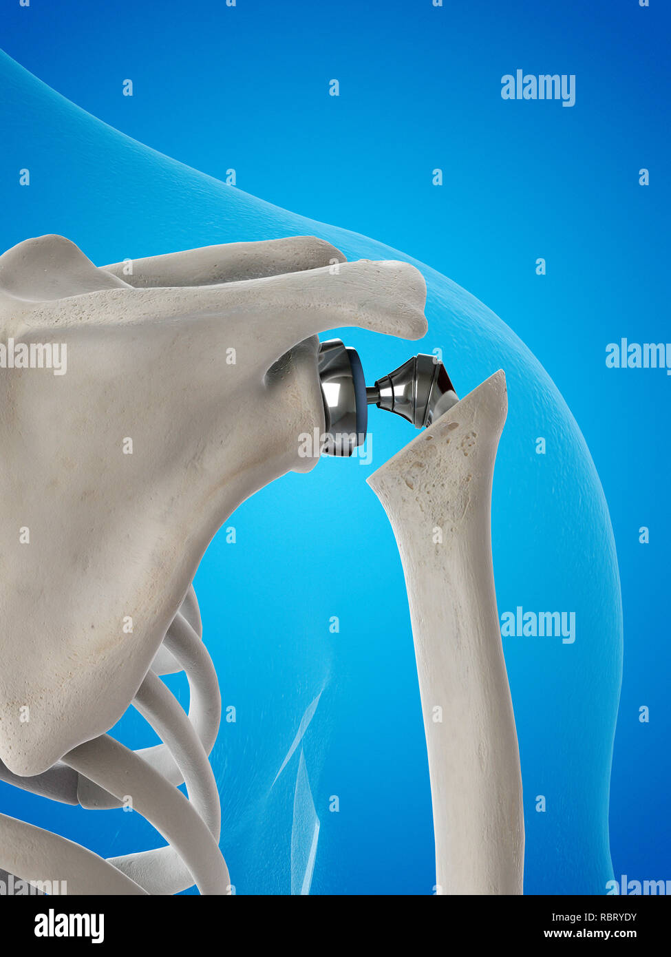 Illustration of a shoulder replacement Stock Photo - Alamy