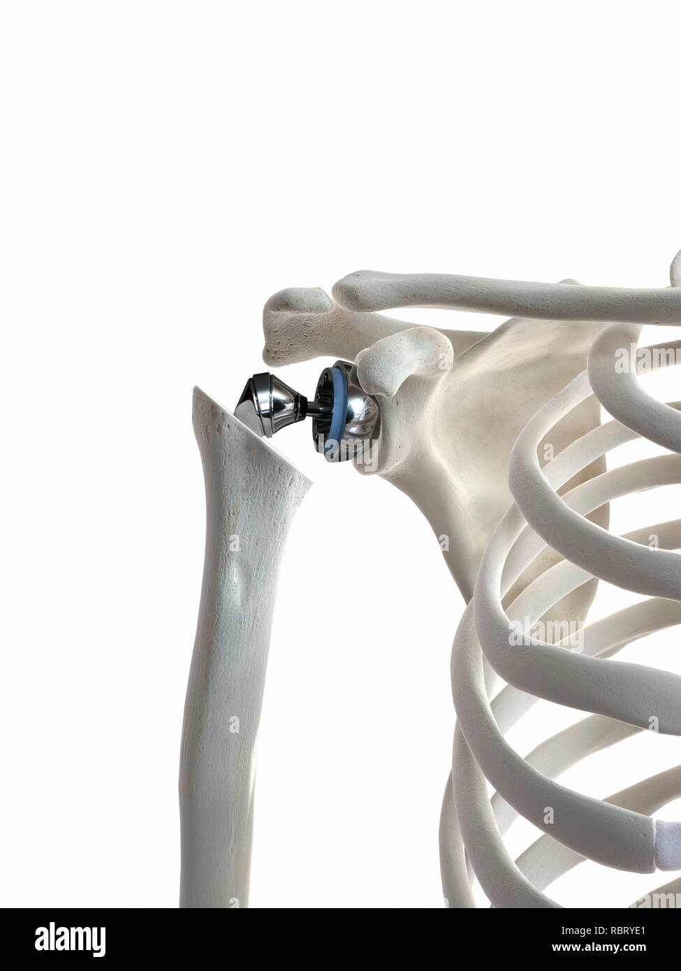 Illustration of a shoulder replacement Stock Photo - Alamy