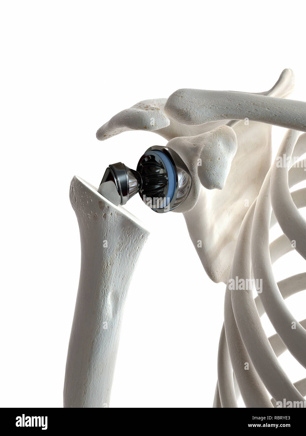 Illustration of a shoulder replacement Stock Photo - Alamy