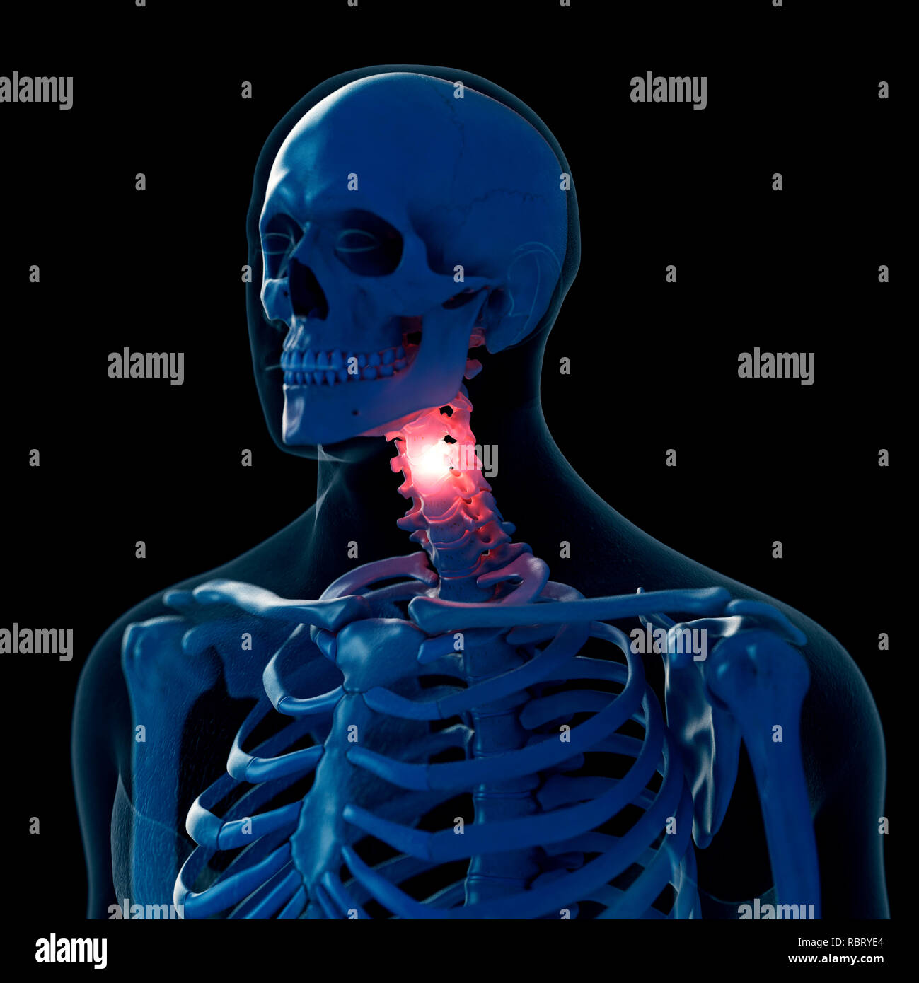 Illustration of a painful neck Stock Photo - Alamy