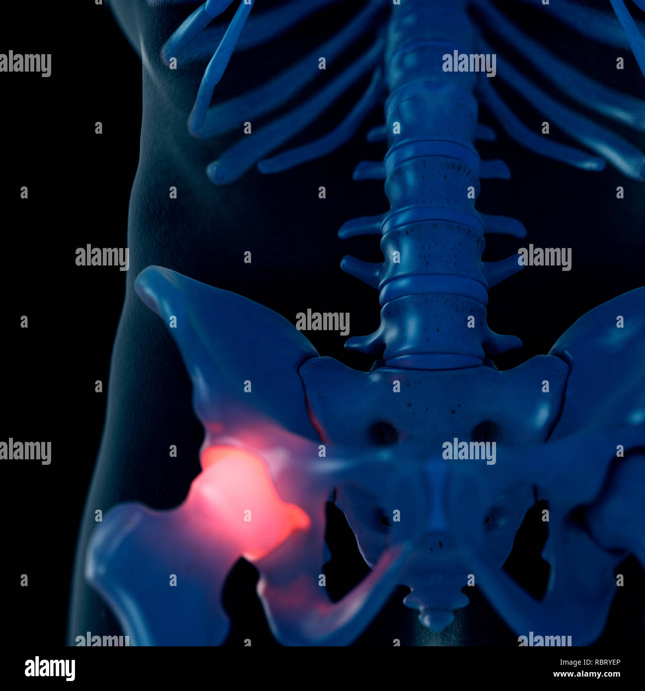 Arthrosis illustration hip hi-res stock photography and images - Alamy