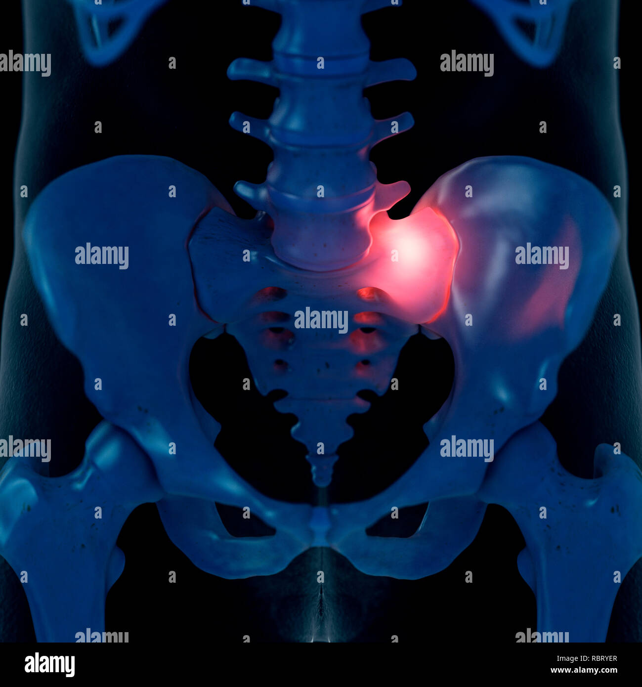Illustration Of A Painful Sacrum Joint Stock Photo Alamy illustration-of-a-painful-sacrum-joint-stock-photo-alamy