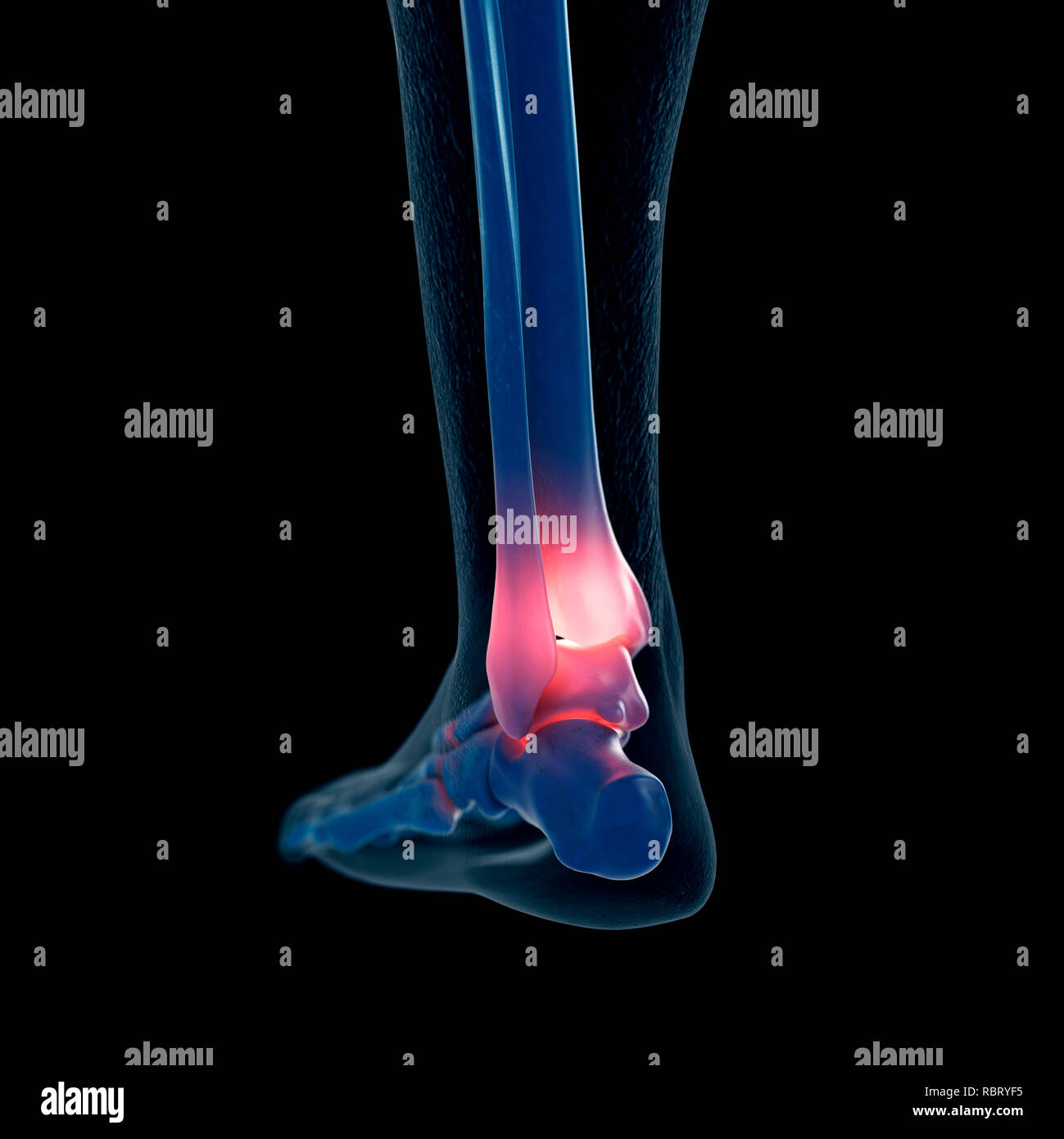 Illustration of a painful ankle Stock Photo - Alamy