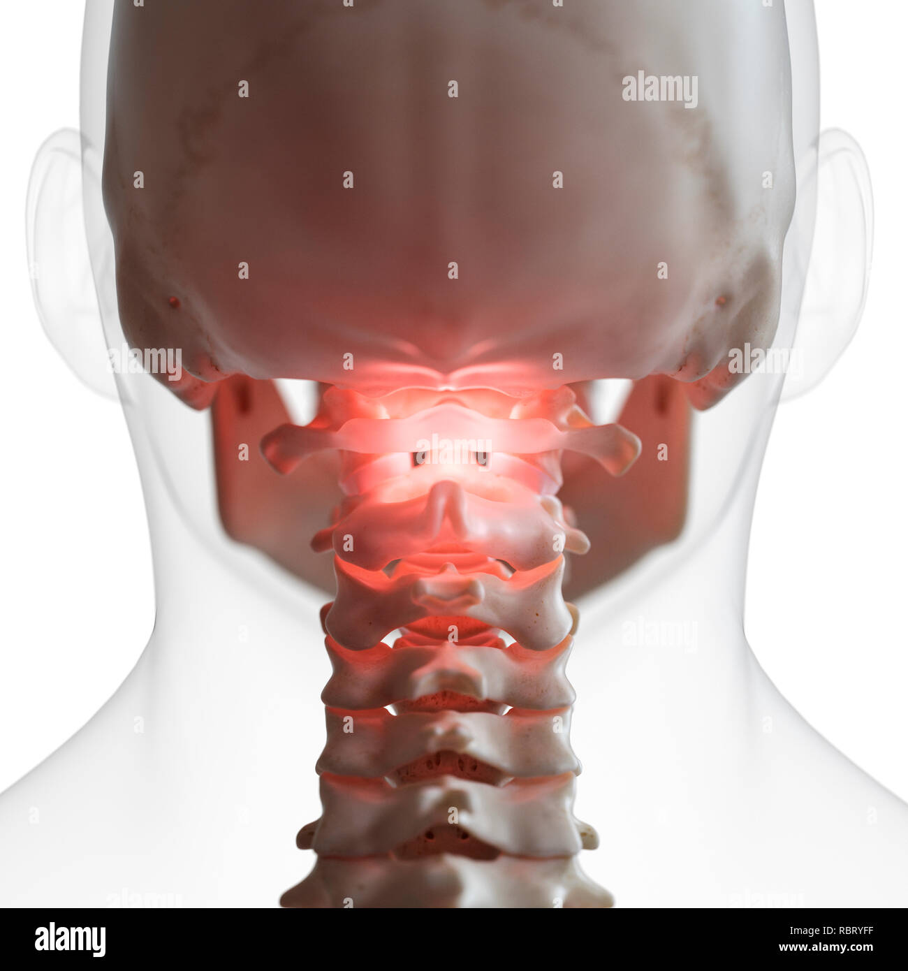 Illustration of a painful atlas bone Stock Photo - Alamy