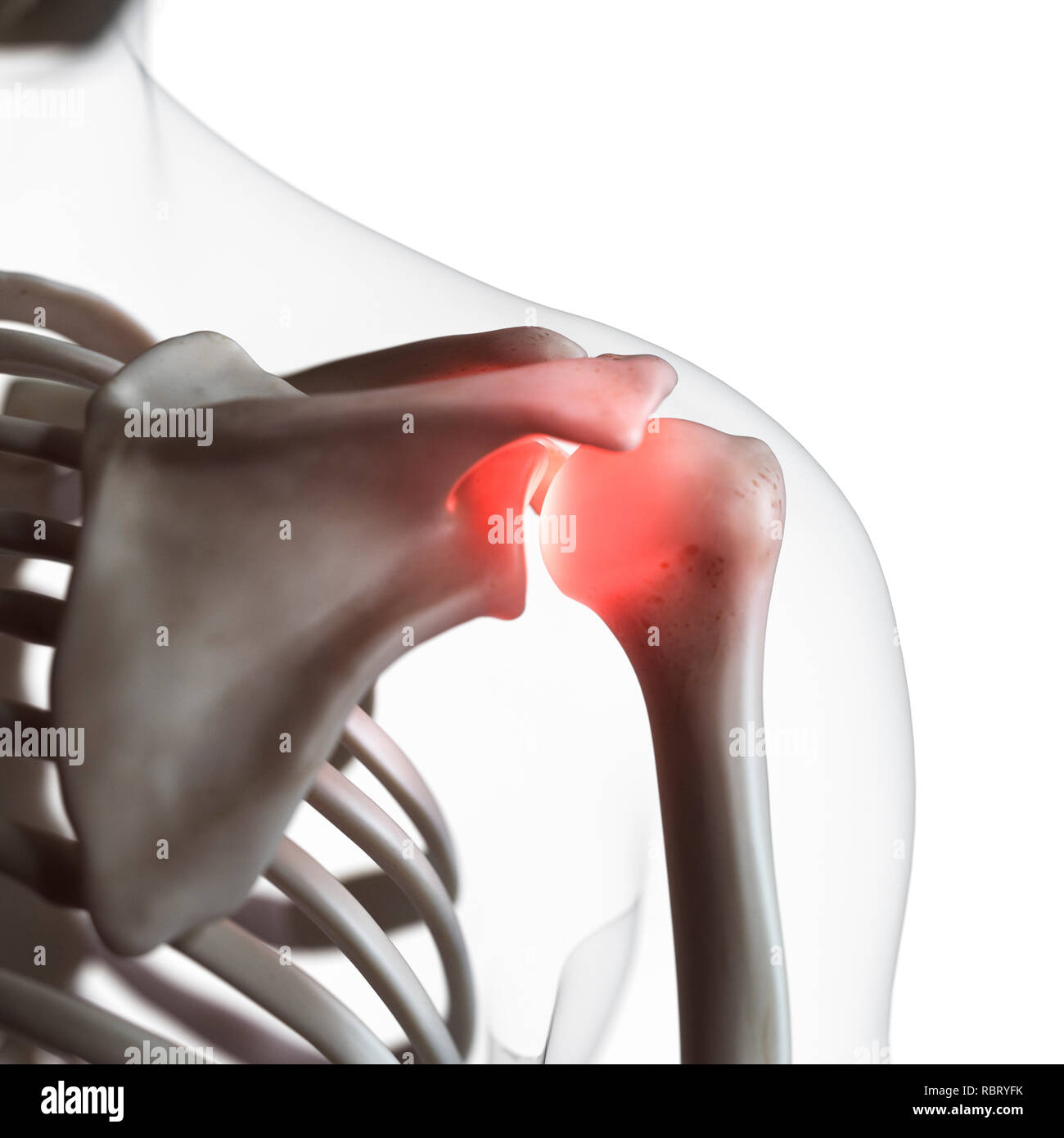 Illustration of a painful shoulder joint Stock Photo - Alamy