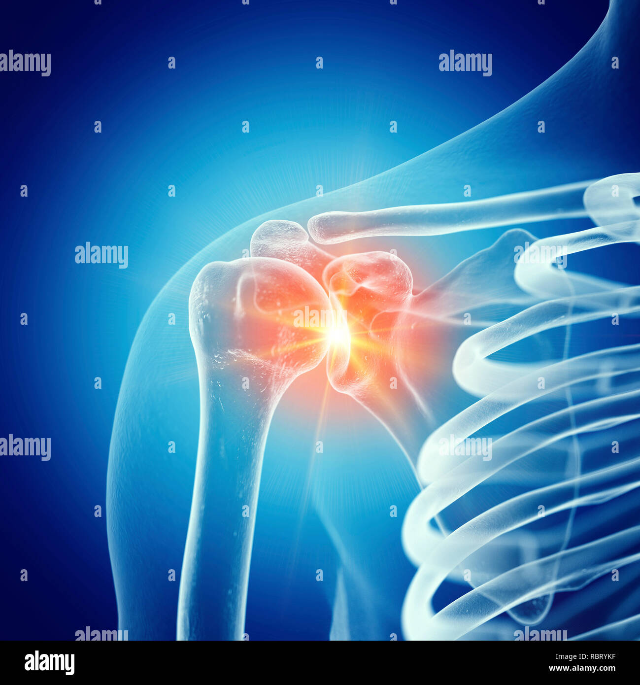 Illustration of a painful shoulder joint Stock Photo - Alamy