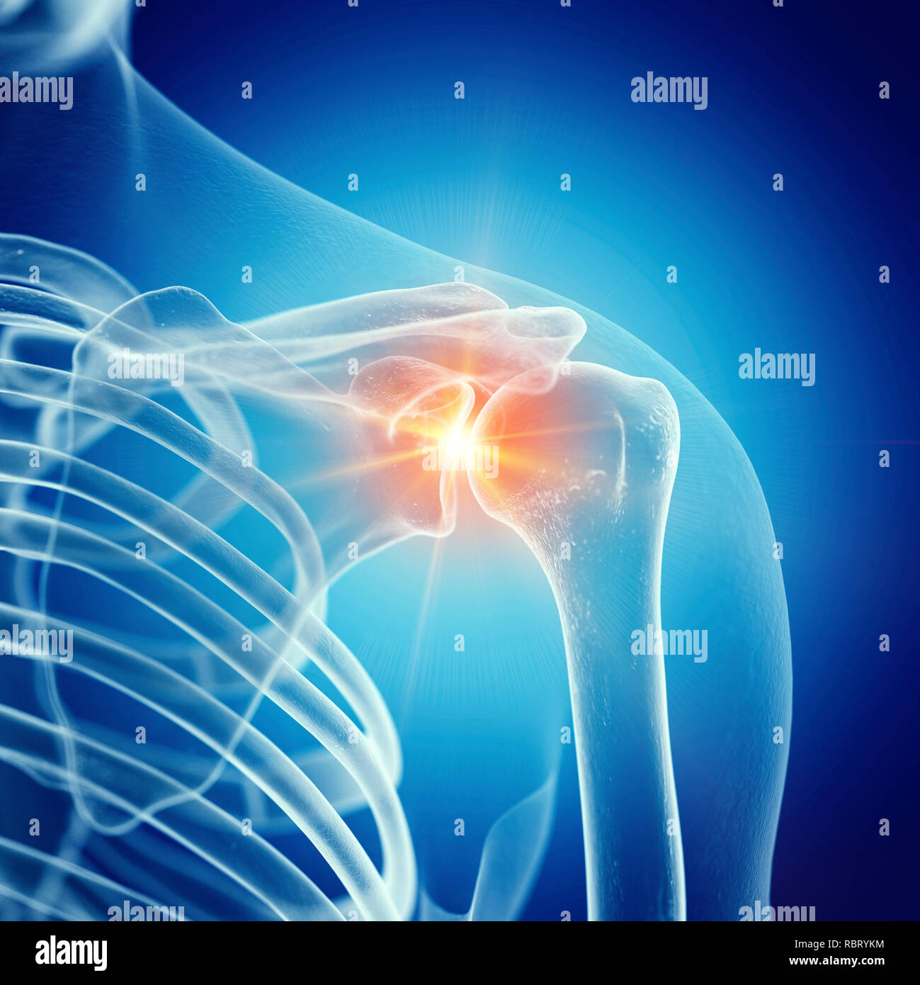 Illustration of a painful shoulder joint Stock Photo - Alamy