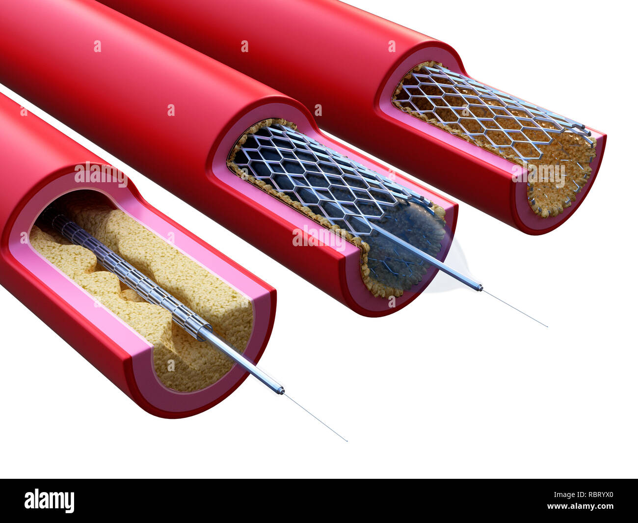 Illustration of a stent being placed Stock Photo - Alamy