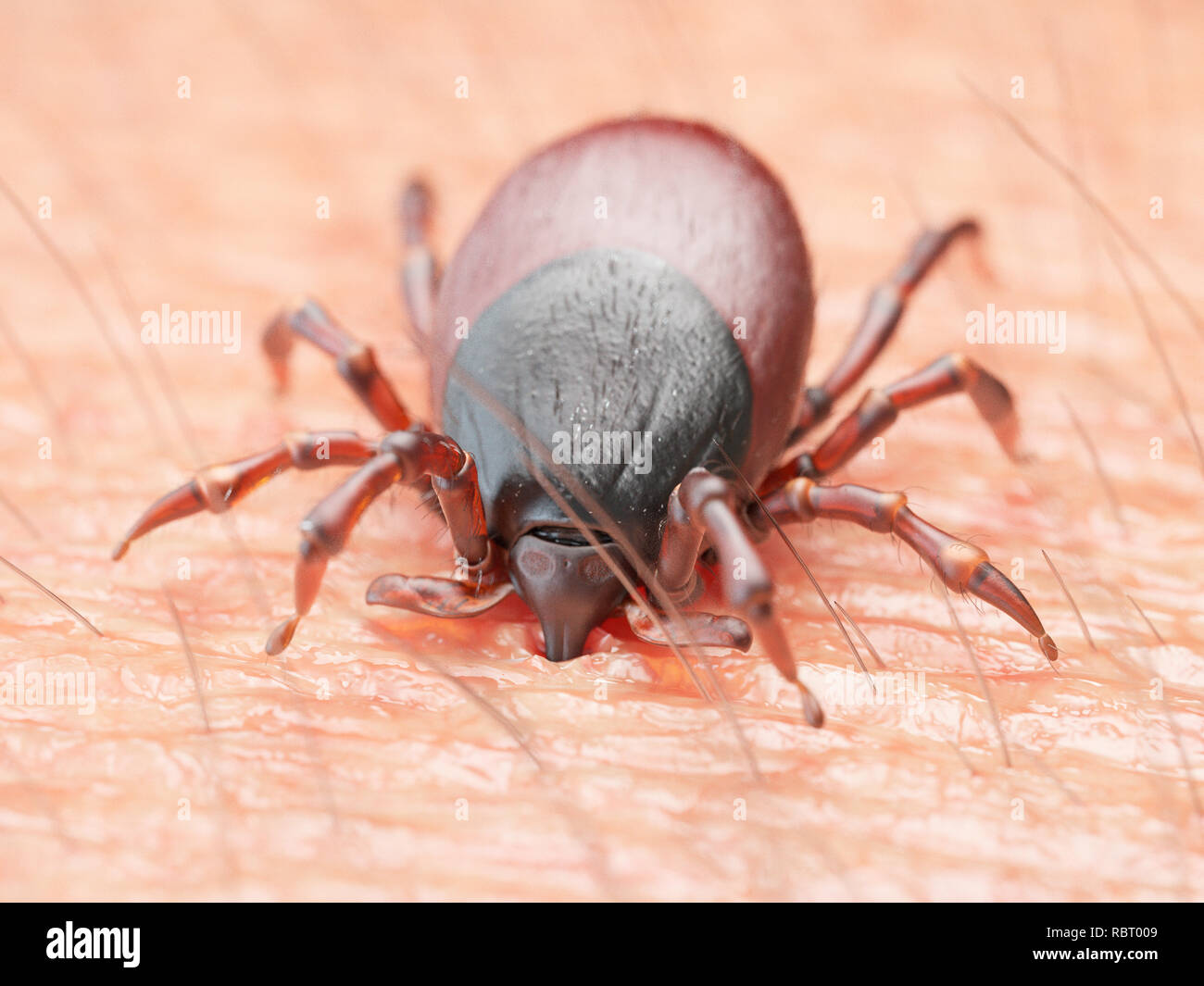 Illustration of a tick biting human skin Stock Photo - Alamy
