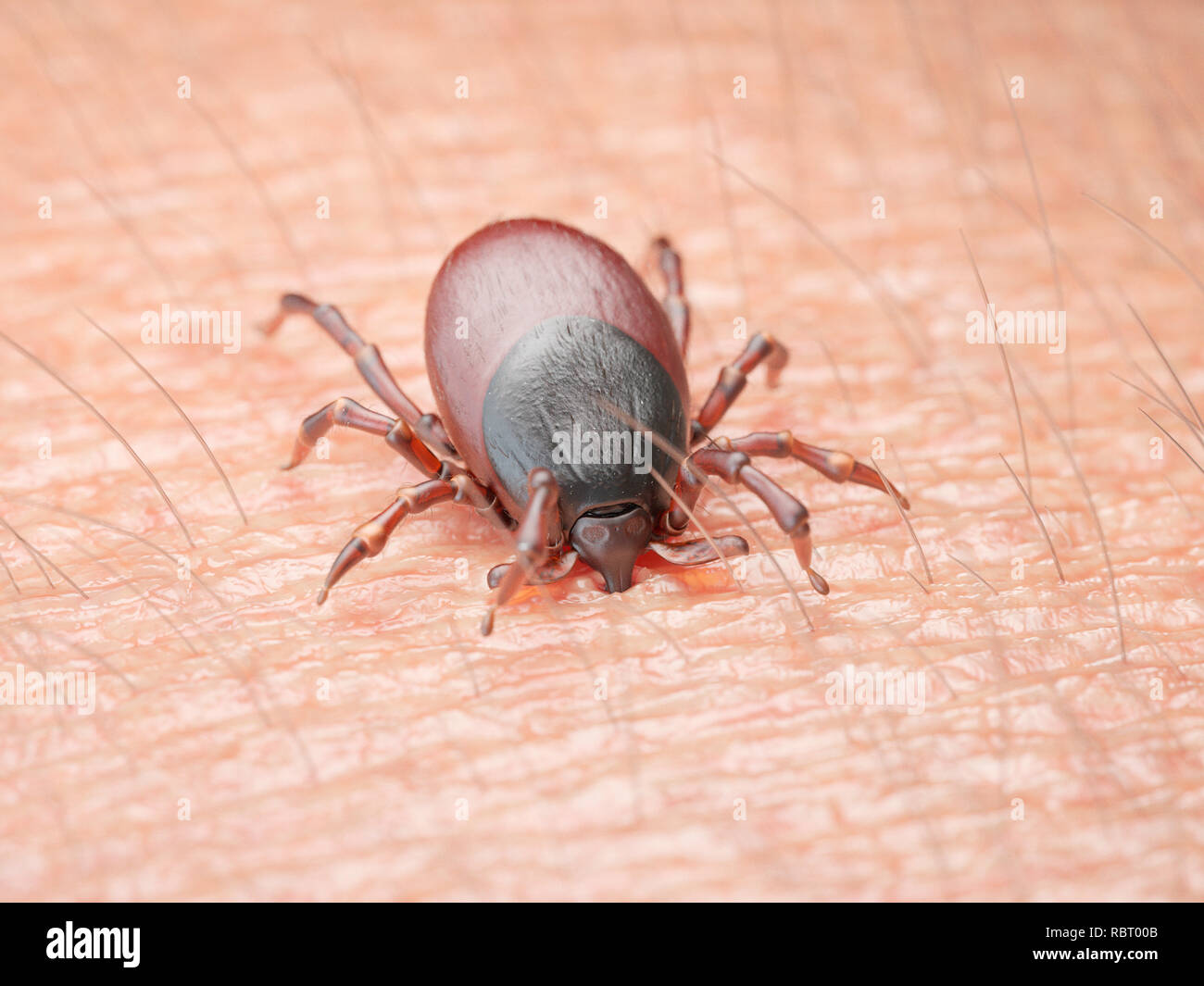 Illustration of a tick biting human skin Stock Photo - Alamy