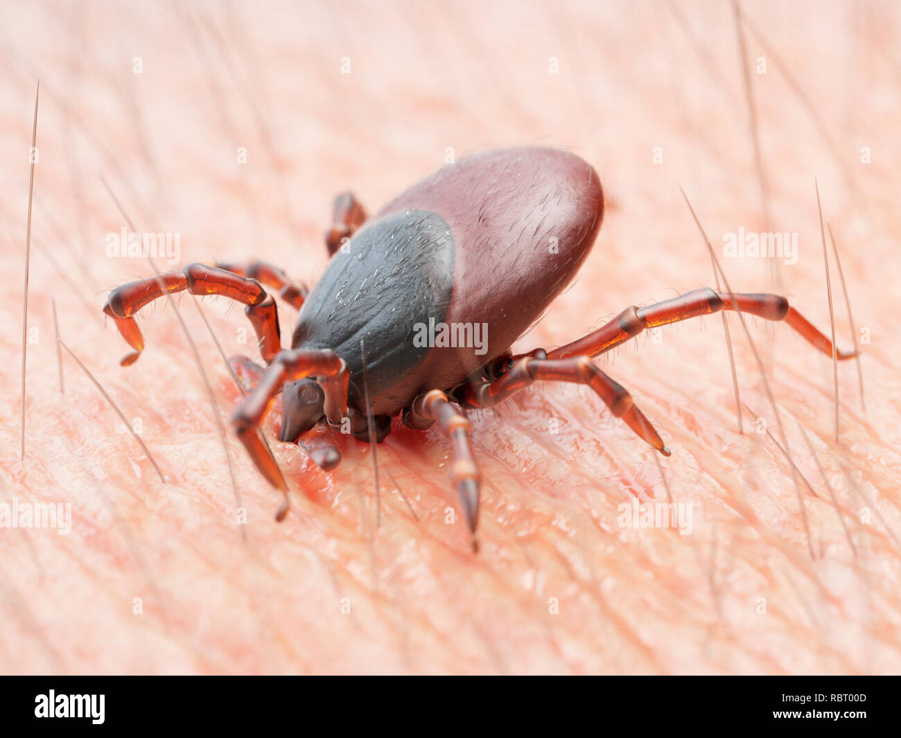 Illustration of a tick biting human skin Stock Photo - Alamy