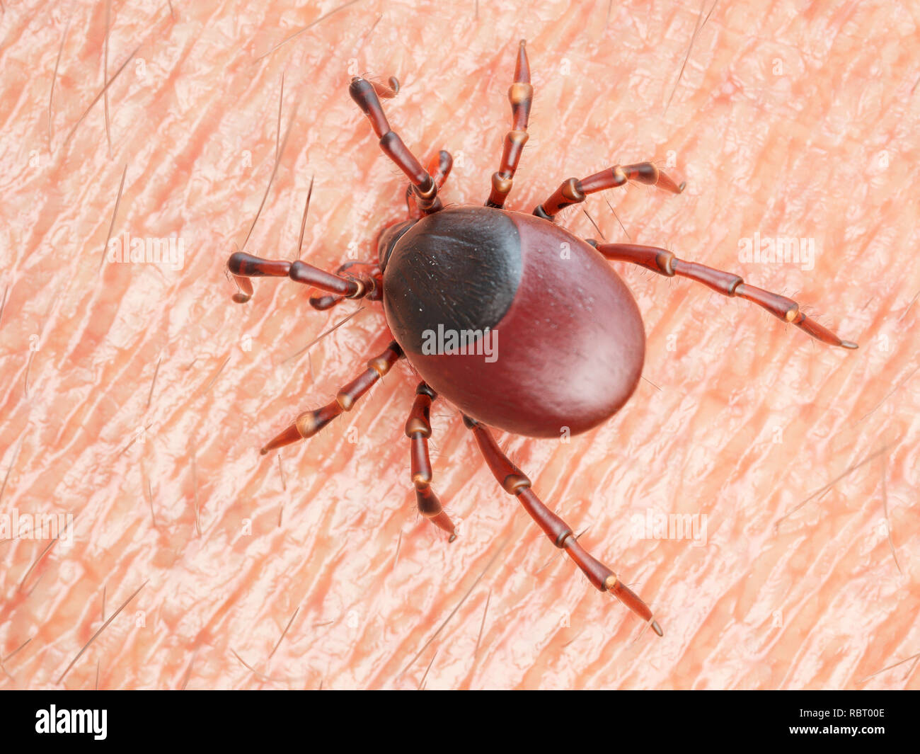 Illustration of a tick biting human skin Stock Photo - Alamy