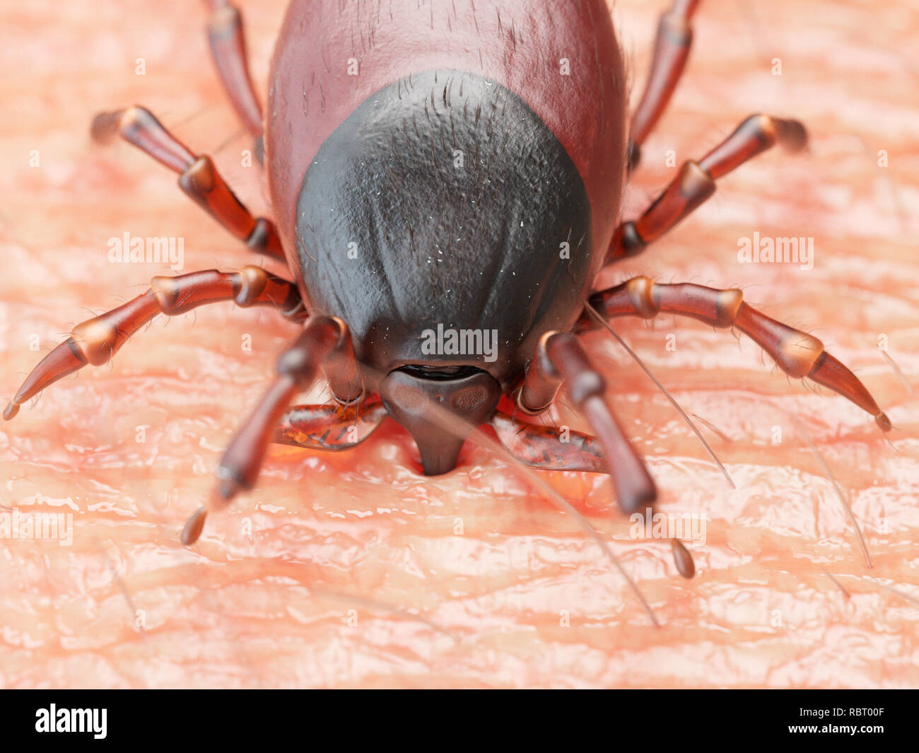 Illustration of a tick biting human skin Stock Photo - Alamy