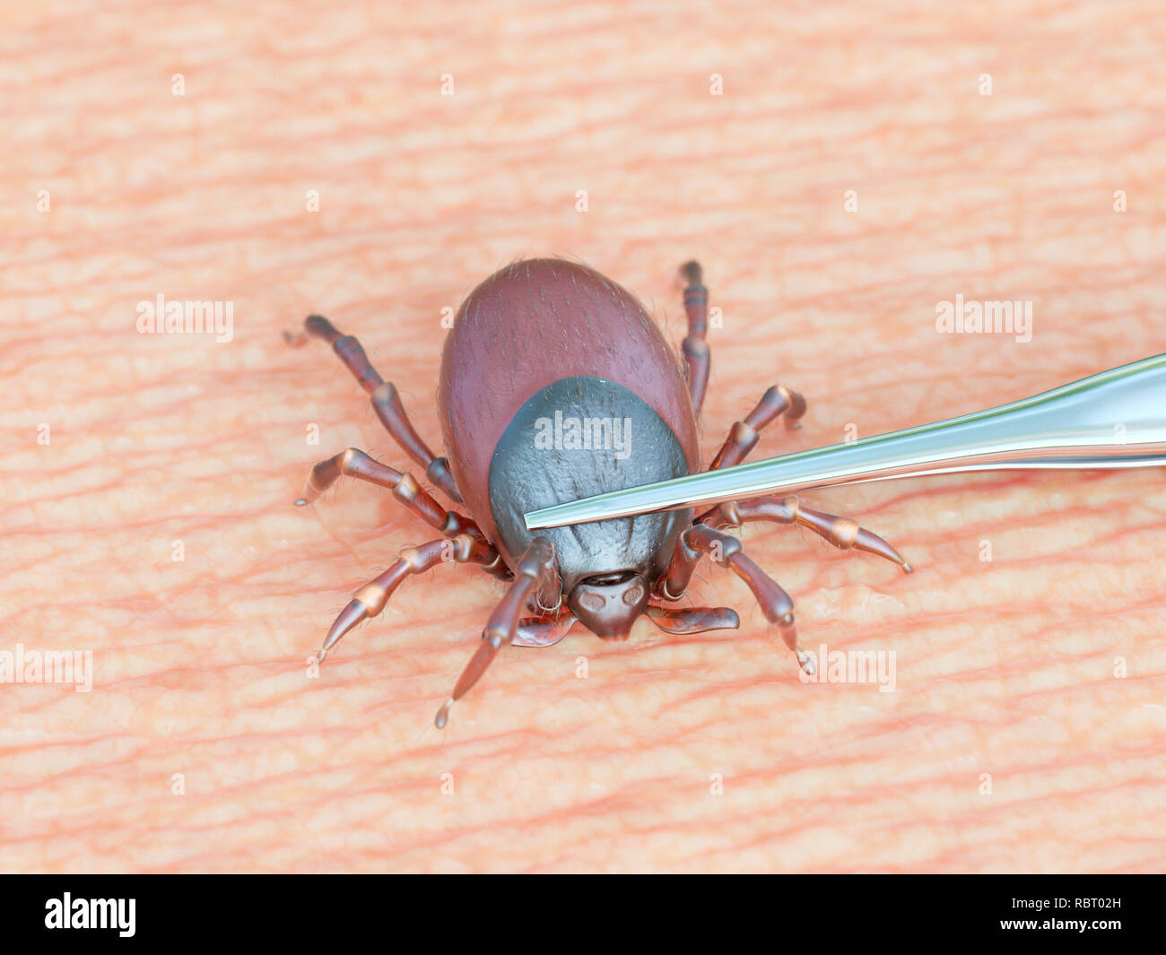 Tick Removal High Resolution Stock Photography and Images - Alamy