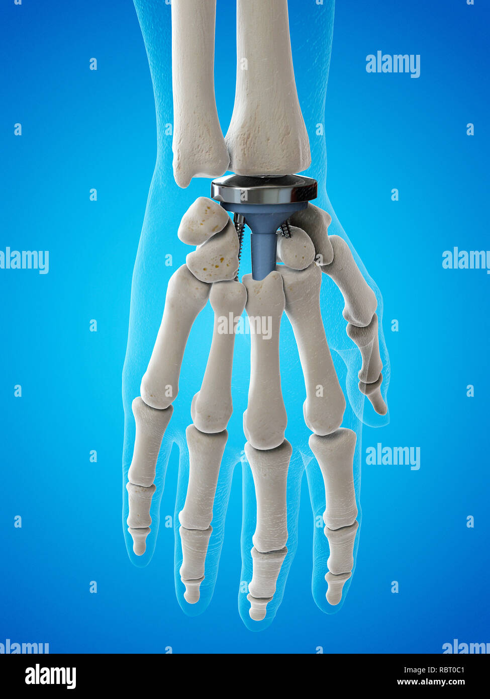 Prosthetic Arm Stock Photos & Prosthetic Arm Stock Images - Alamy