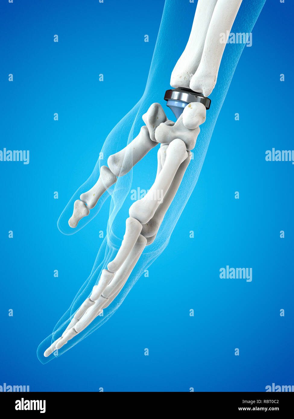 Hand surgery illustration hi-res stock photography and images - Alamy