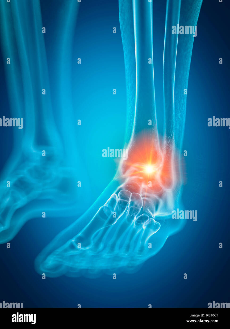 Illustration of a painful ankle Stock Photo - Alamy