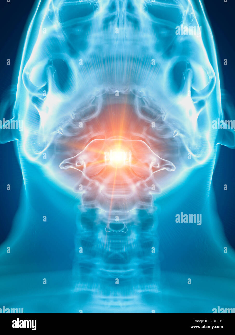 Illustration of a painful atlas bone Stock Photo - Alamy