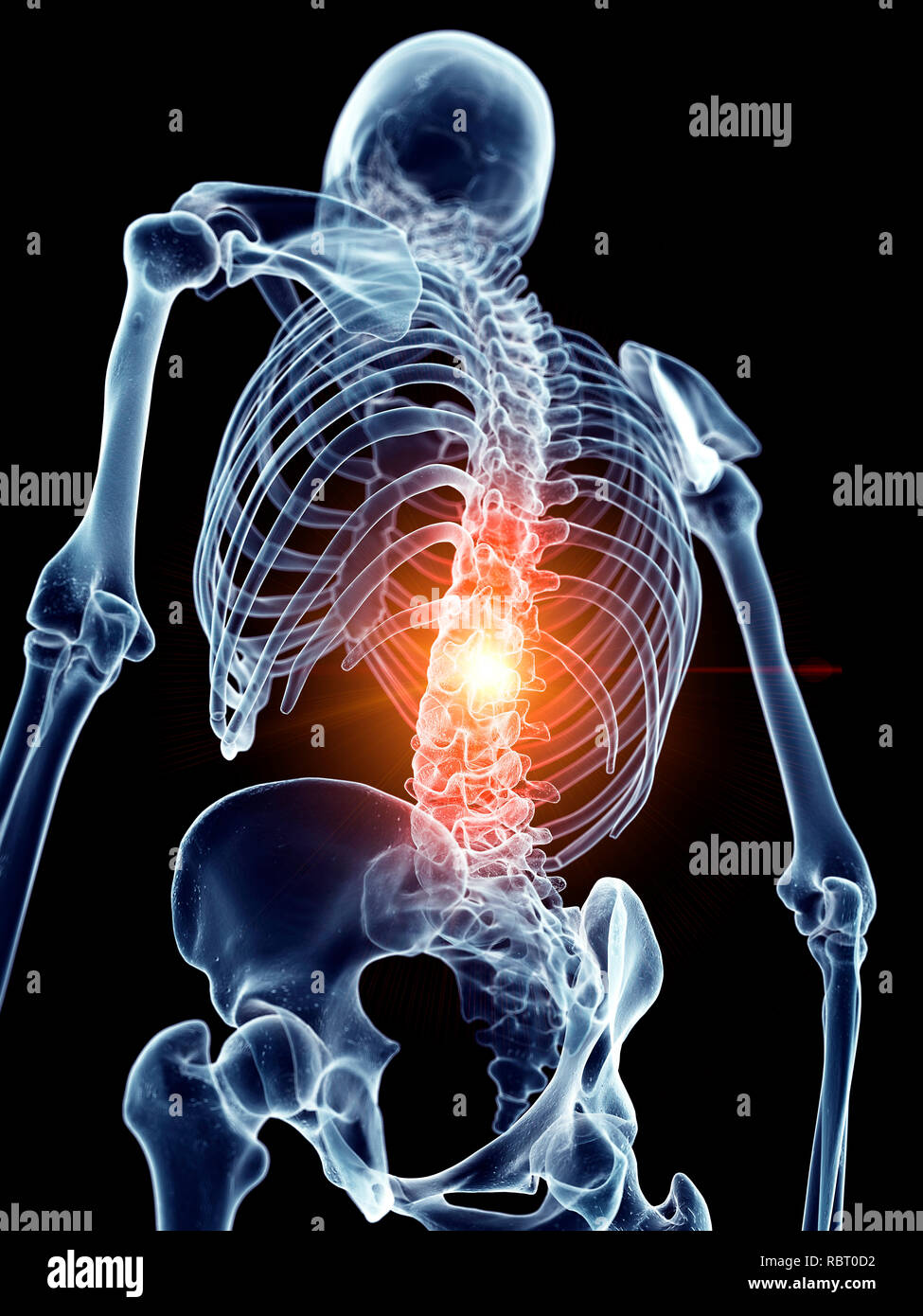 Illustration of a painful spine Stock Photo - Alamy
