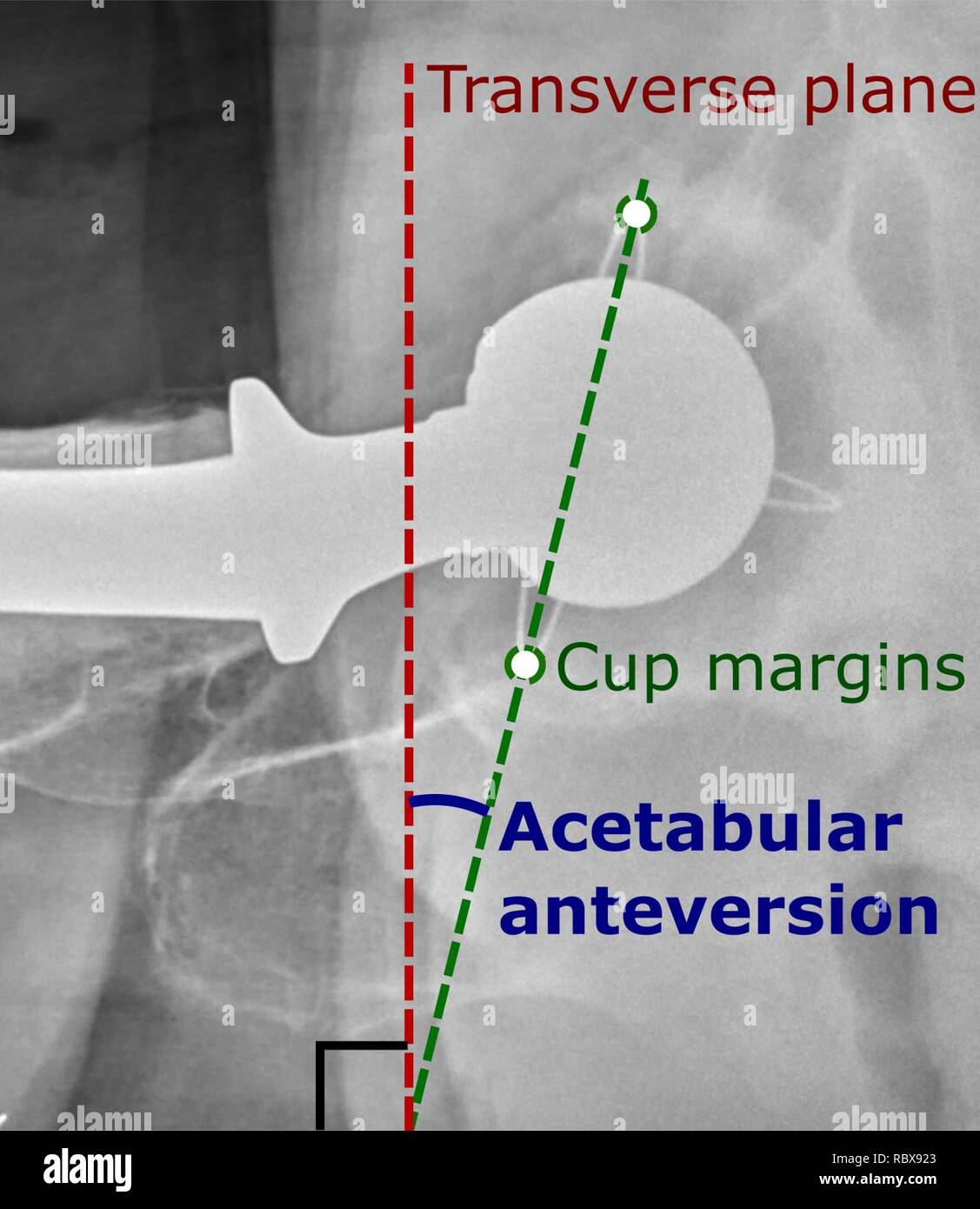 Acetabular anteversion of hip prosthesis Stock Photo - Alamy