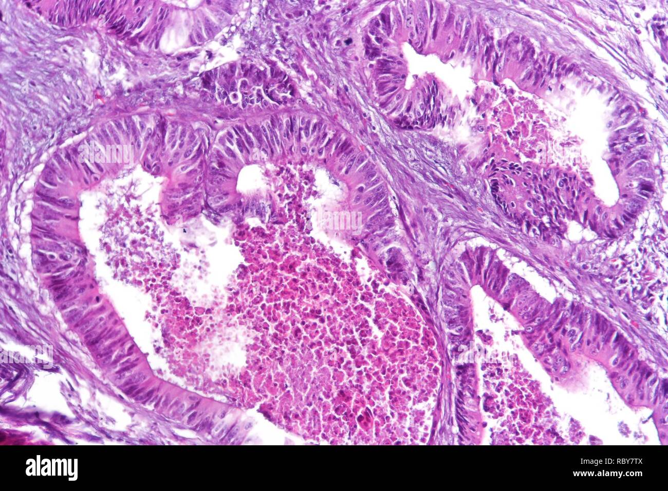 Adenocarcinoma (intestinal type) of the urinary bladder, high mag Stock ...