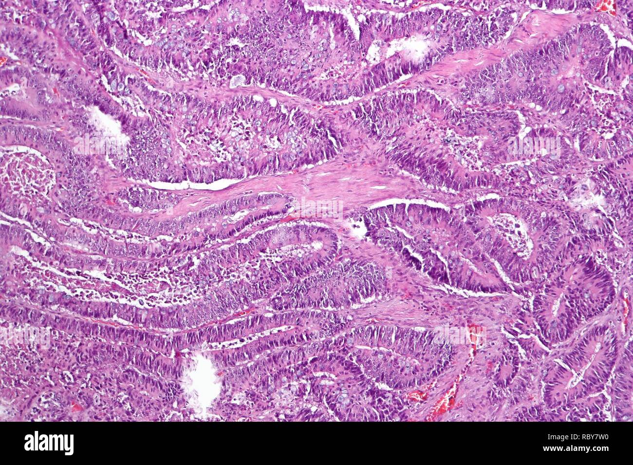 Adenocarcinoma (intestinal type) of the urinary bladder, intermed. mag ...