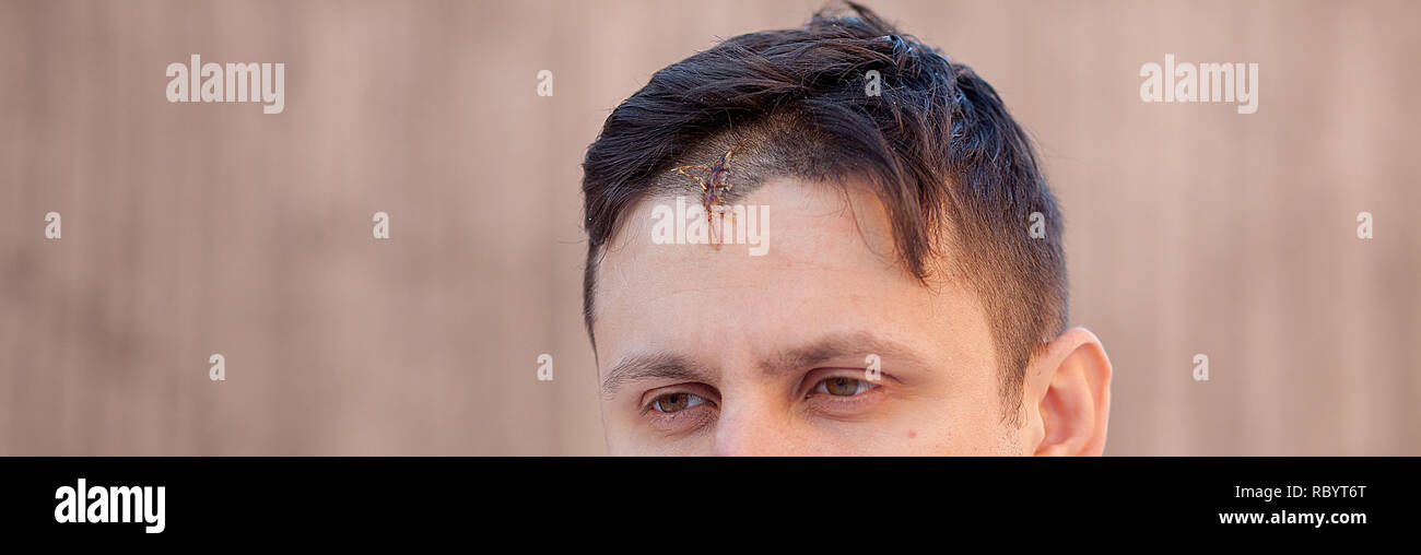 Suture wound at skull with wires, Postoperative stitching craniectomy ...