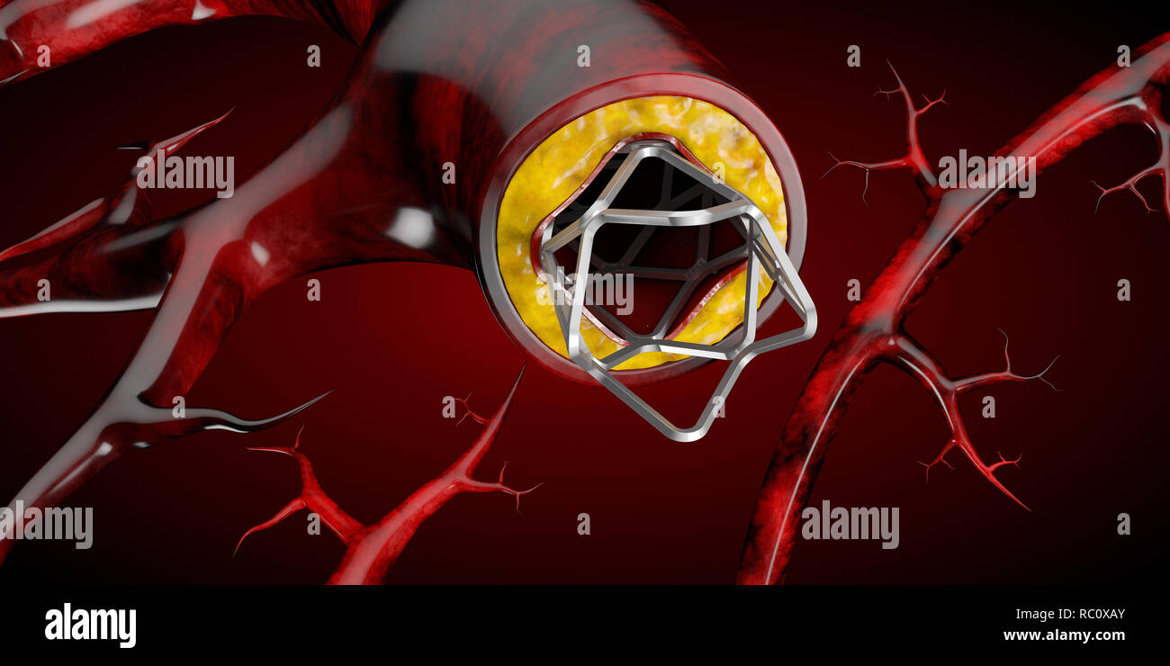 Medical concept coronary angioplasty stent hi-res stock photography and ...