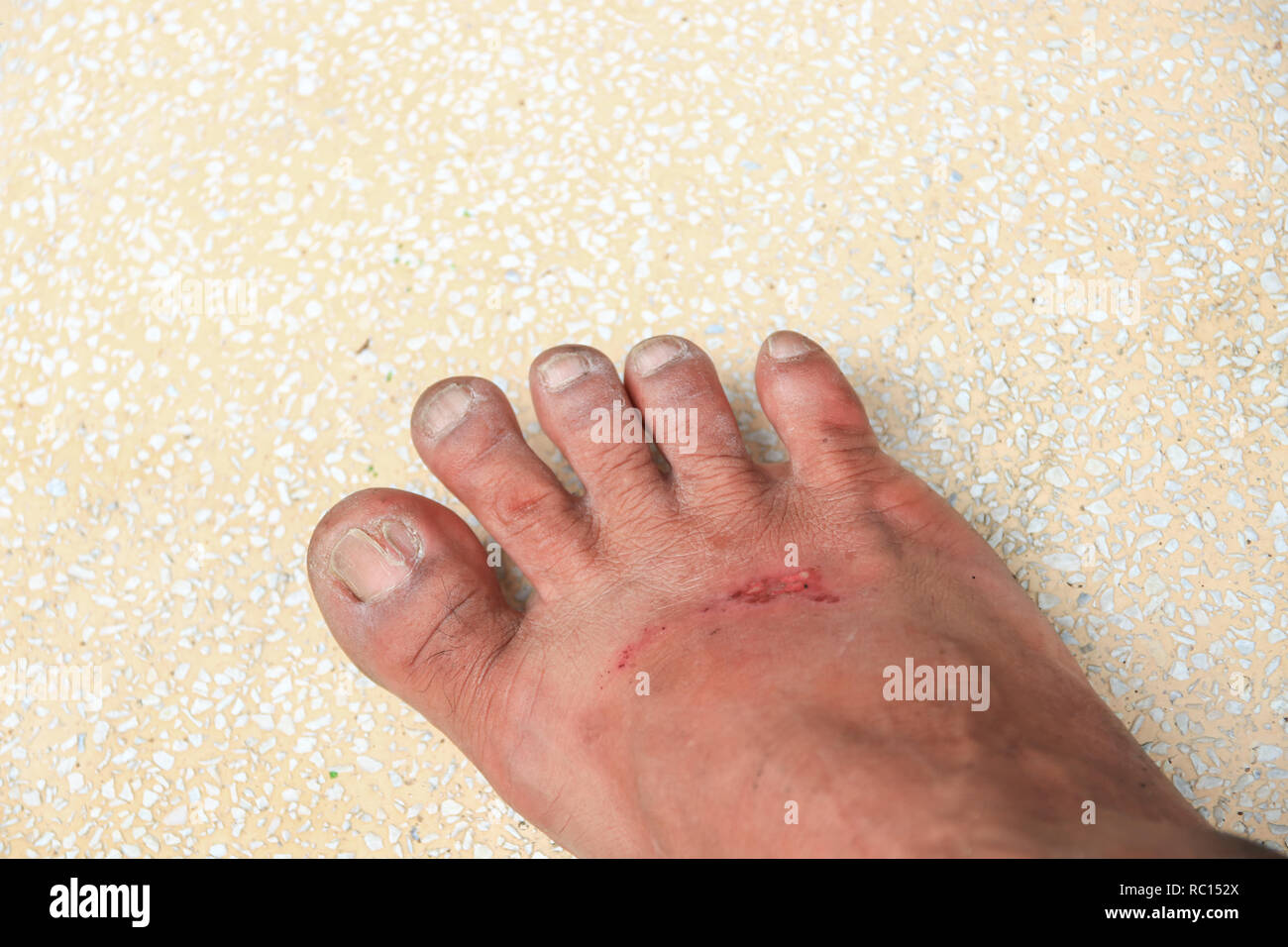 foot wound becomes infected select focus with shallow depth of field ...