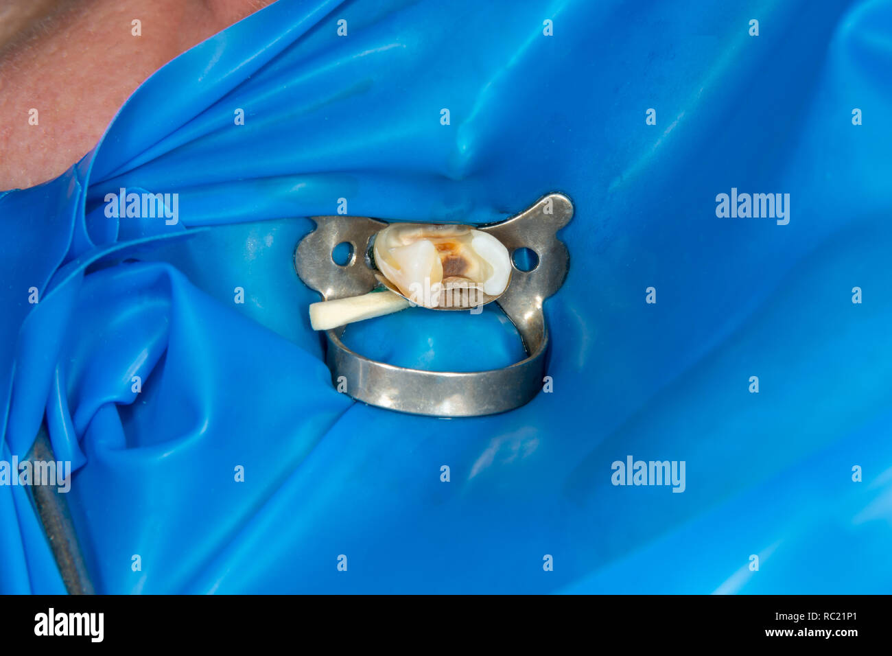 restoration of a rotten tooth decayed tooth close-up. The concept of ...