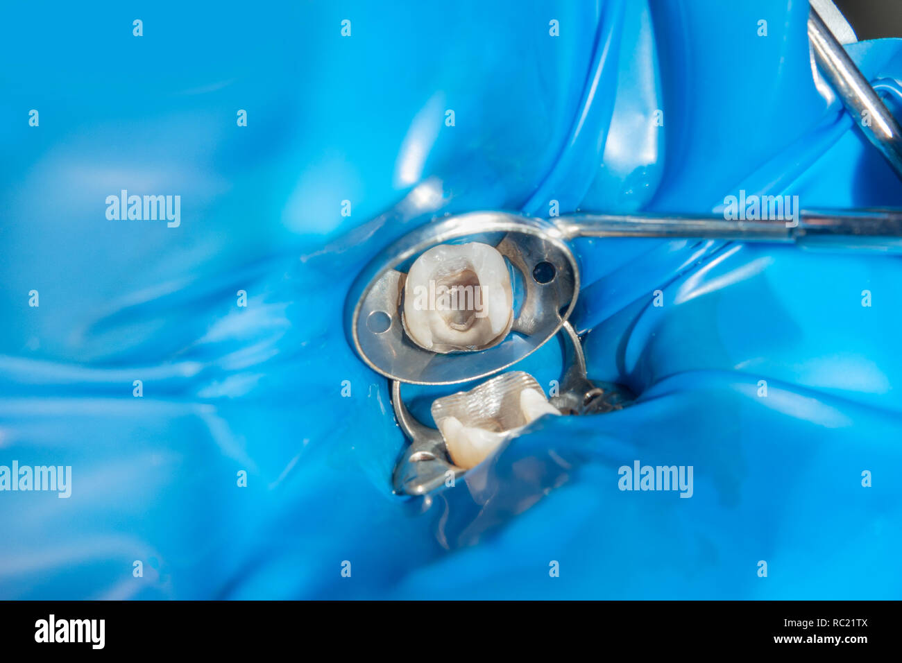 restoration of a rotten tooth decayed tooth close-up. The concept of ...