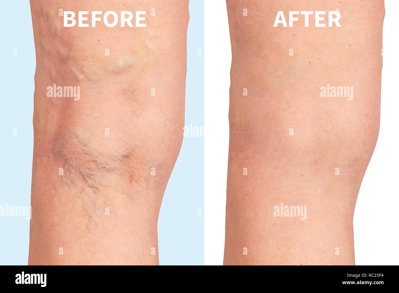 varicose veins on the skin macro close up circulation problem medicine ...