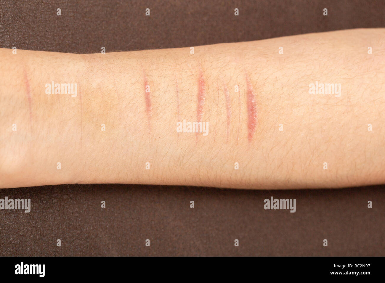 Suicide attempt hi-res stock photography and images - Alamy