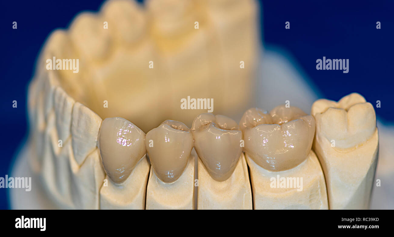 Ceramic zirconia teeth Stock Photo - Alamy
