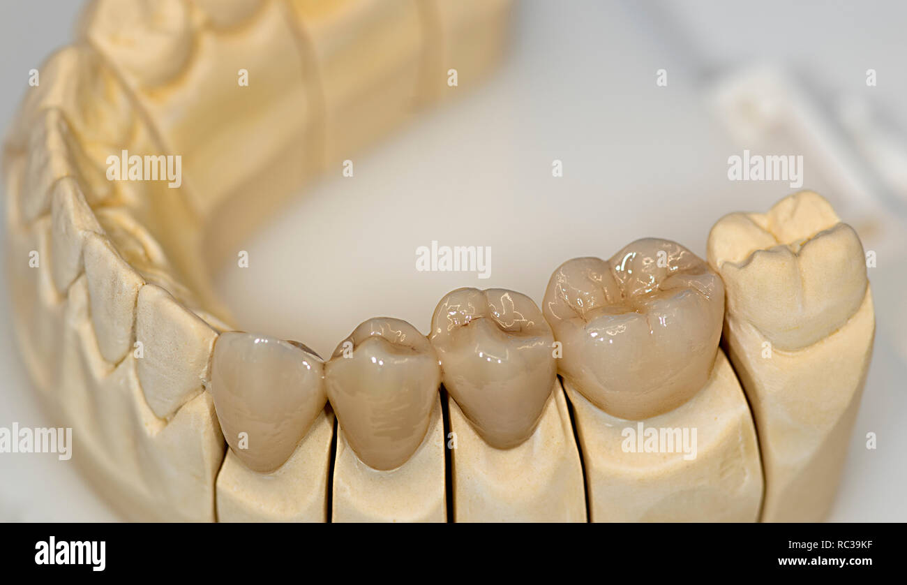 Ceramic zirconia teeth Stock Photo - Alamy