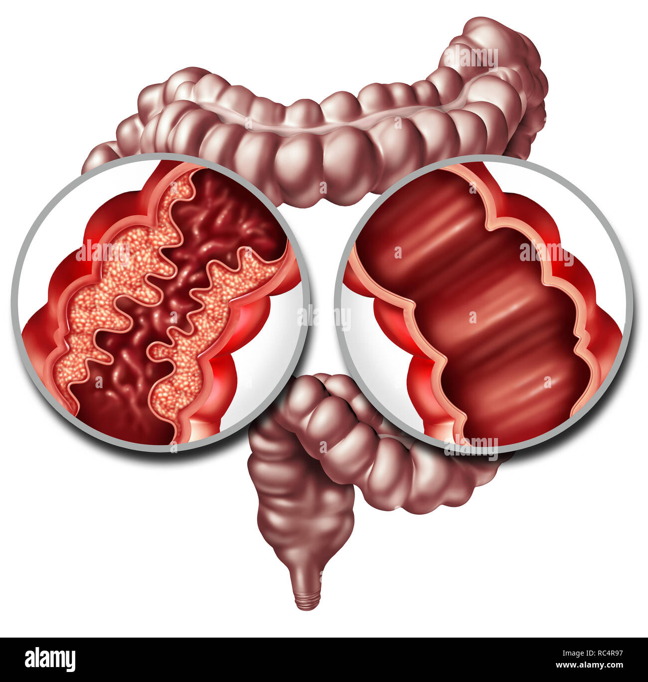 Crohn's disease of the colon hi-res stock photography and images - Alamy