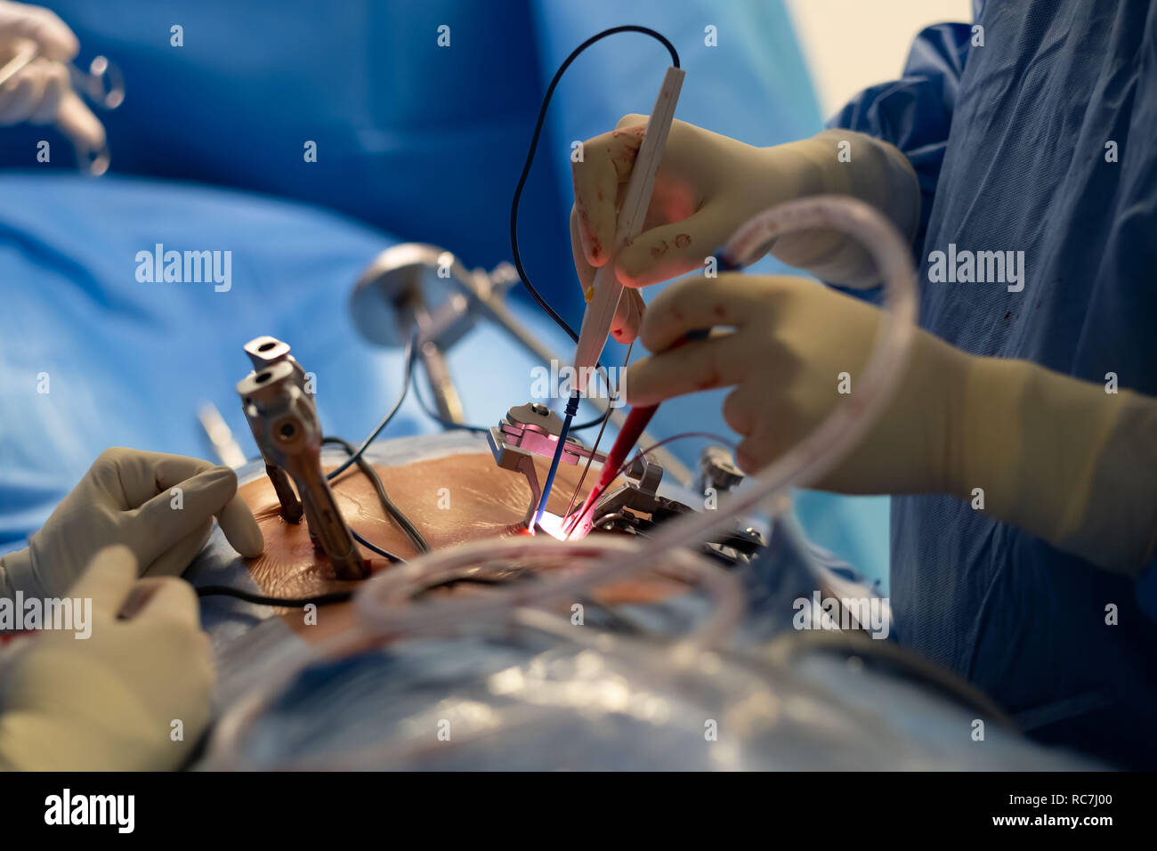 Doctors performing spine surgery using neuronavigation computer ...