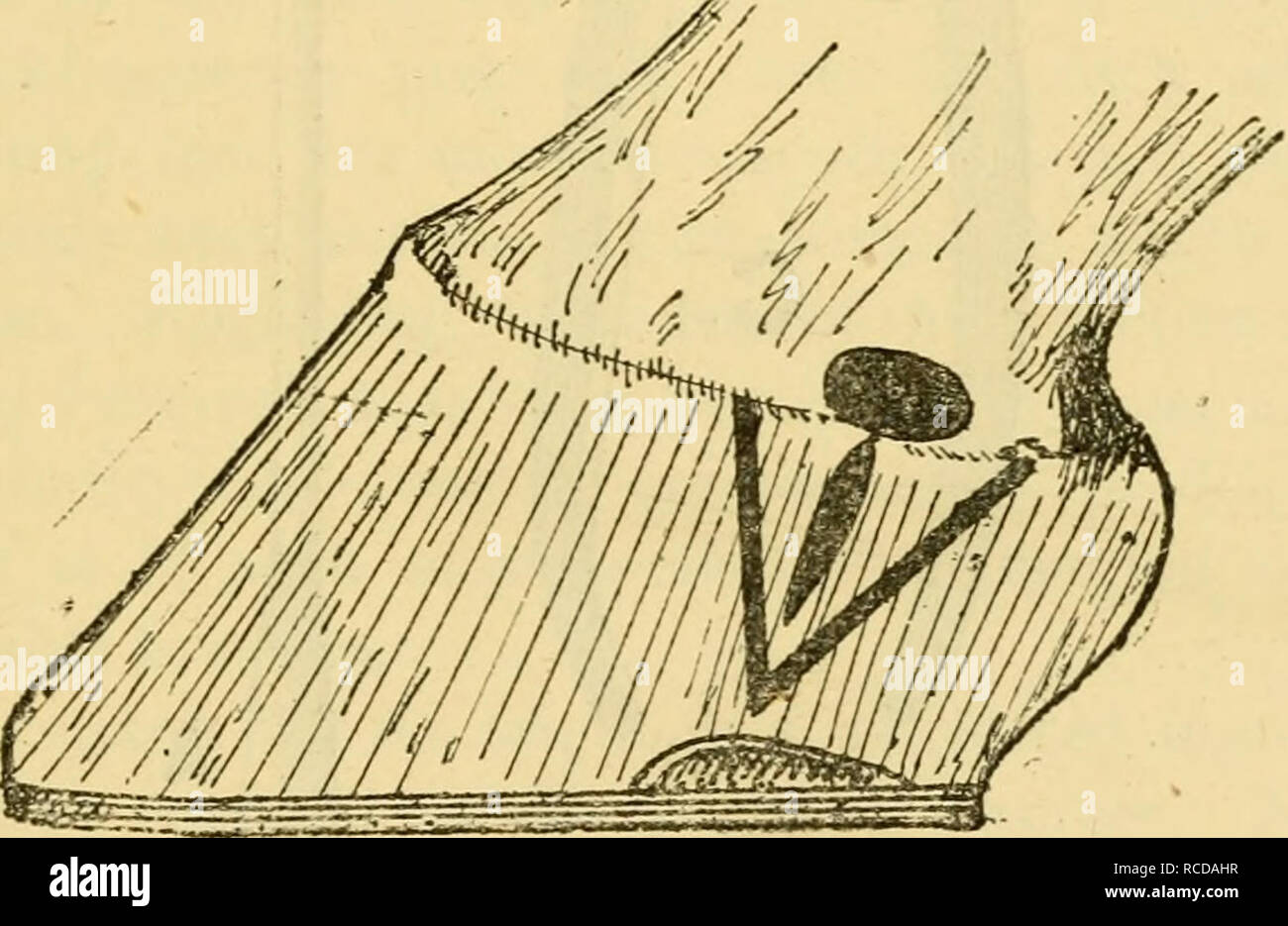 Surgery of bran hi-res stock photography and images - Alamy