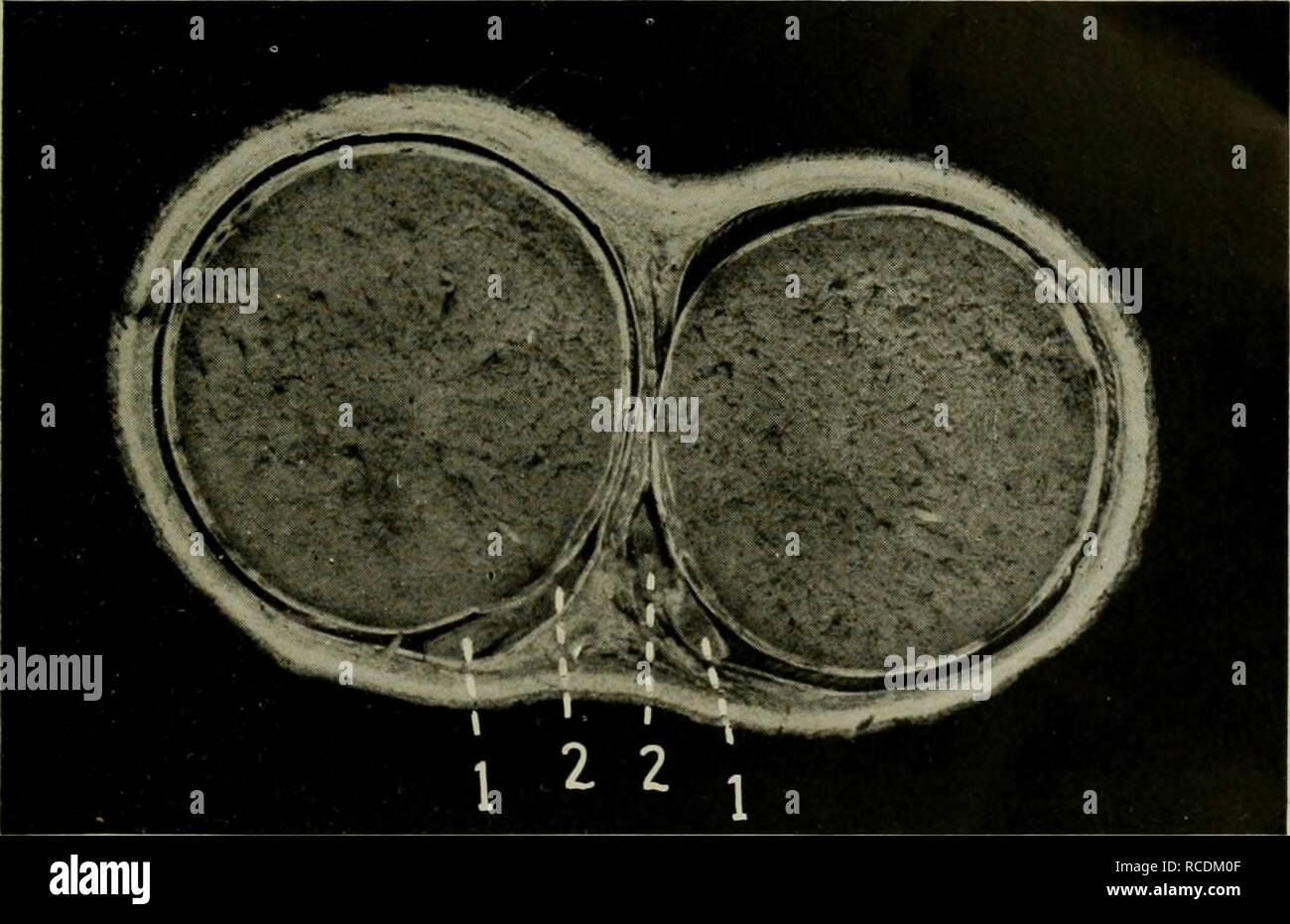 Gubernaculum Testis Tail