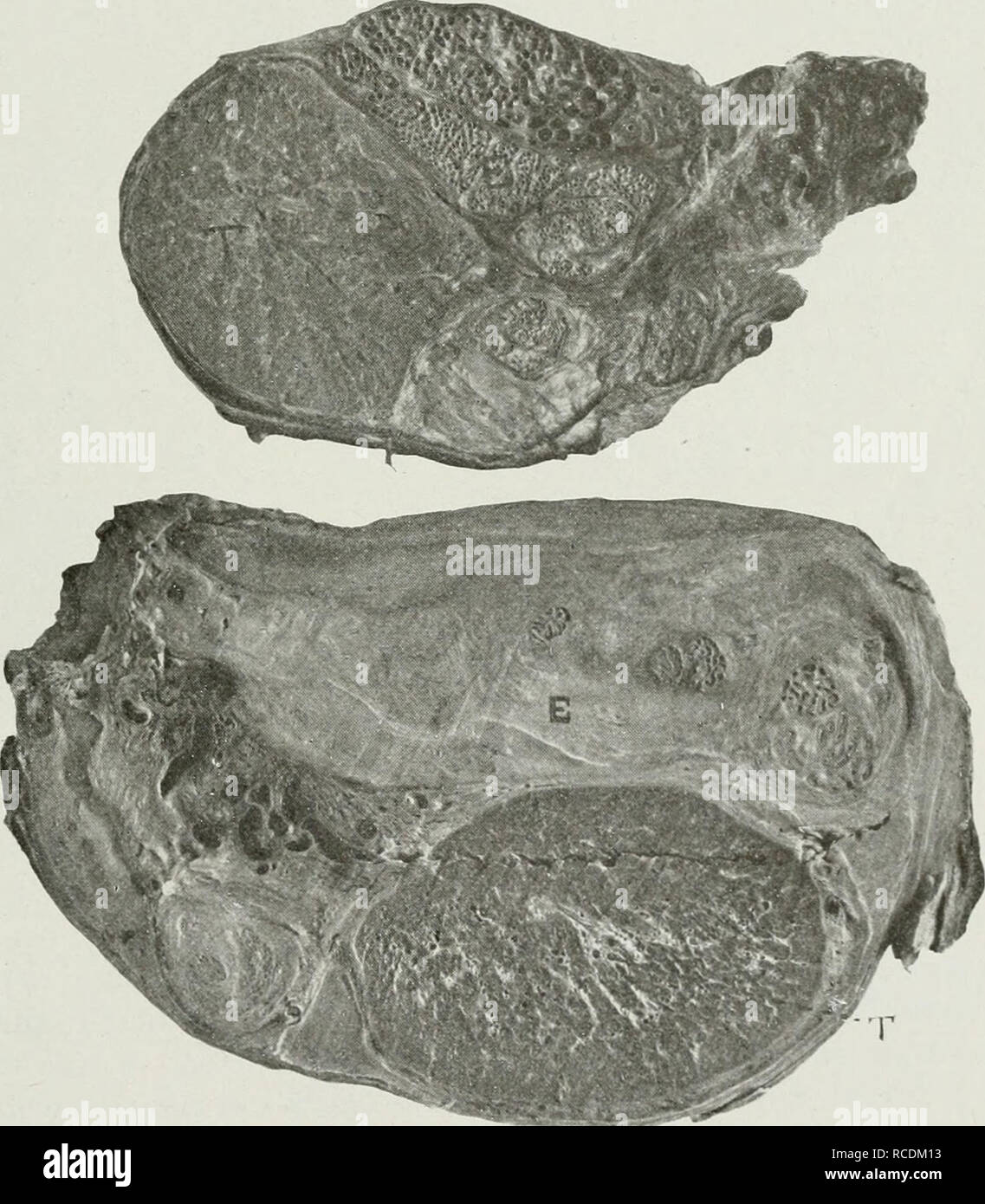 Epididymitis hi-res stock photography and images - Alamy