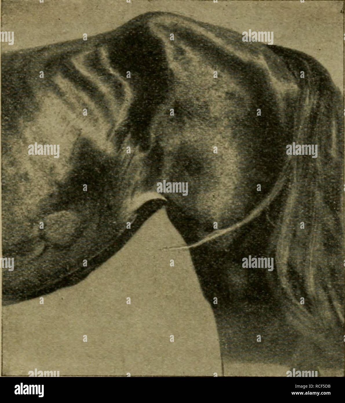 Erythema Multiforme High Resolution Stock Photography and Images - Alamy