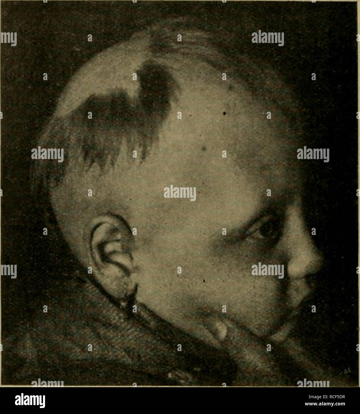 Alopecia areata images hi-res stock photography and images - Alamy