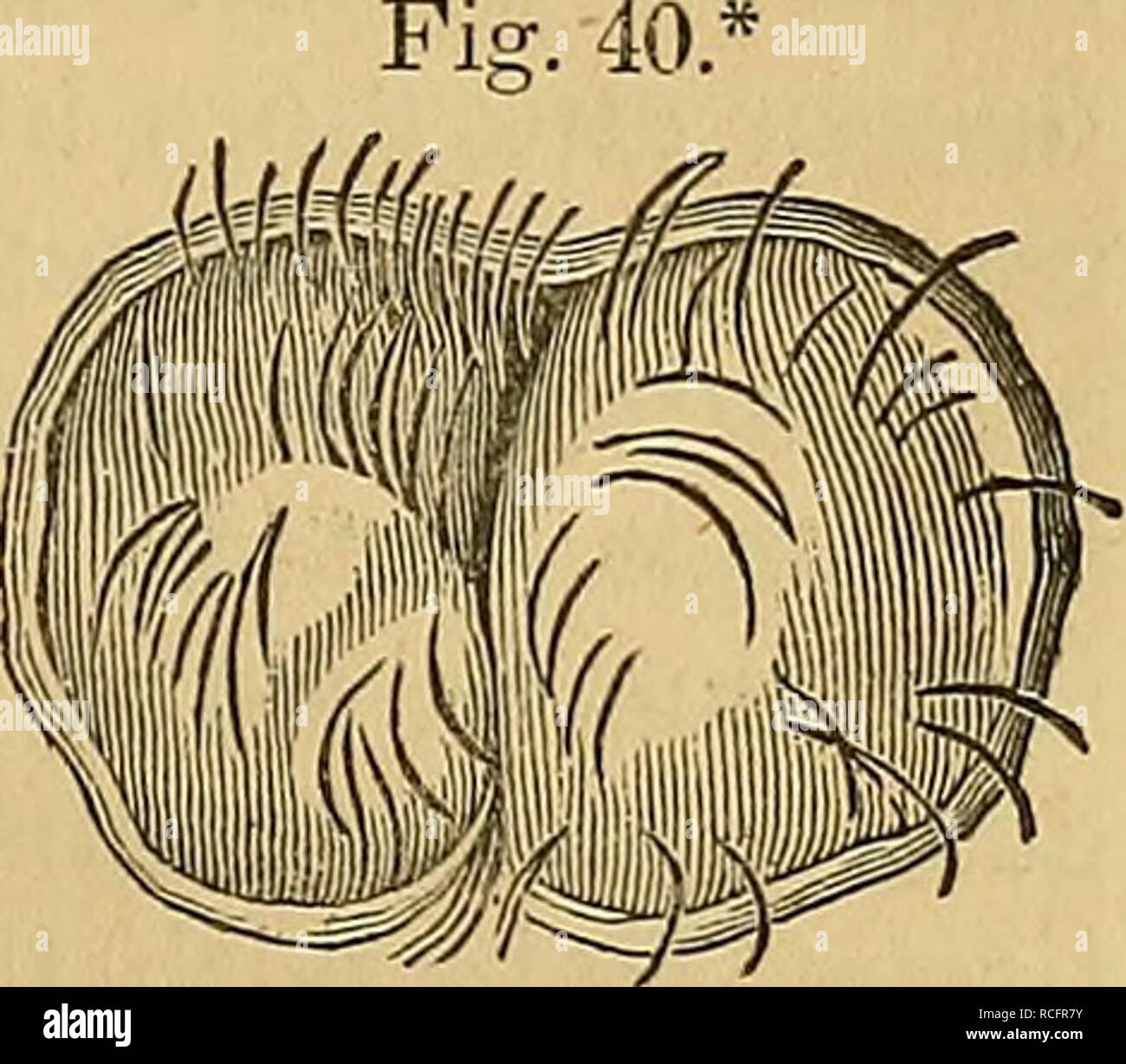 Malignant hemorrhage hi-res stock photography and images - Alamy