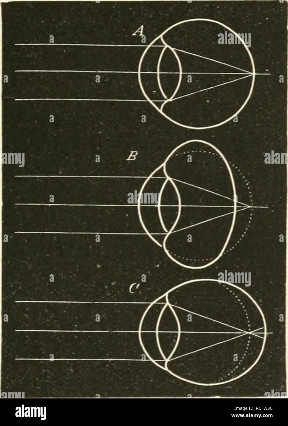 Myopia and corrected hi-res stock photography and images - Alamy