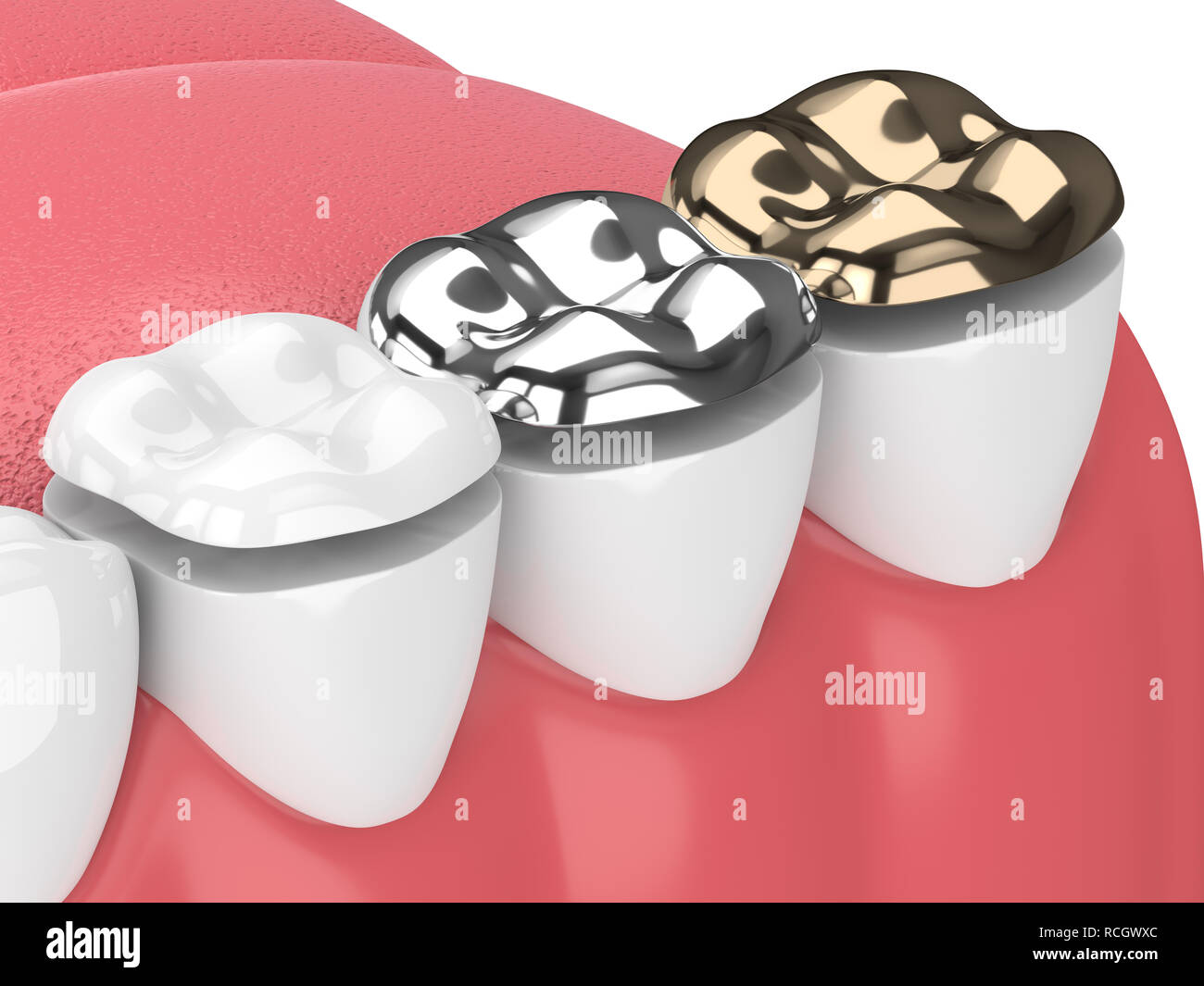 3d render of jaw with teeth and three types of onlay over white Stock ...