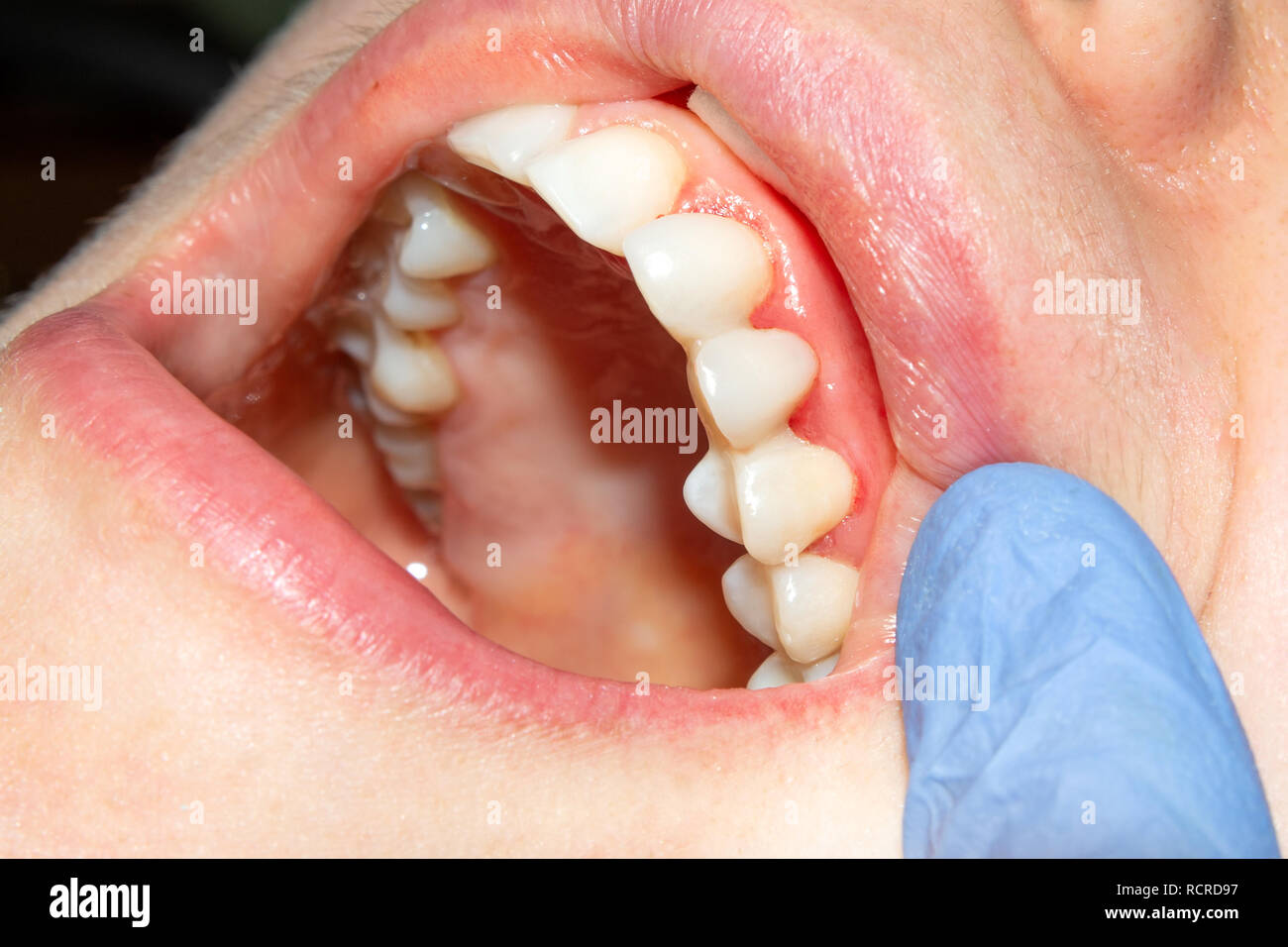 two chewing side teeth of the upper jaw after treatment of caries ...